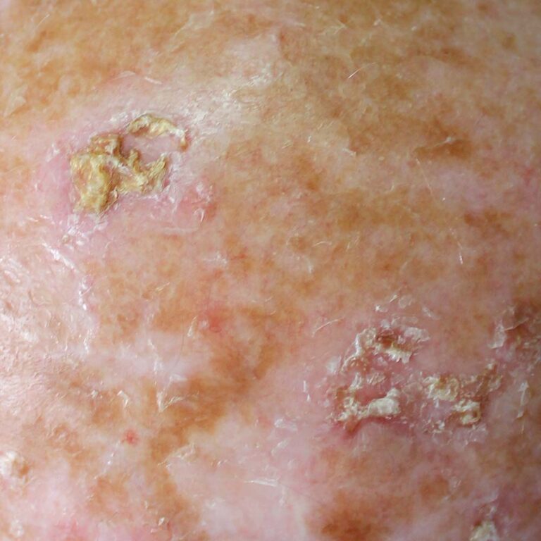 Actinic Keratosis - Cynthia Rogers, MD